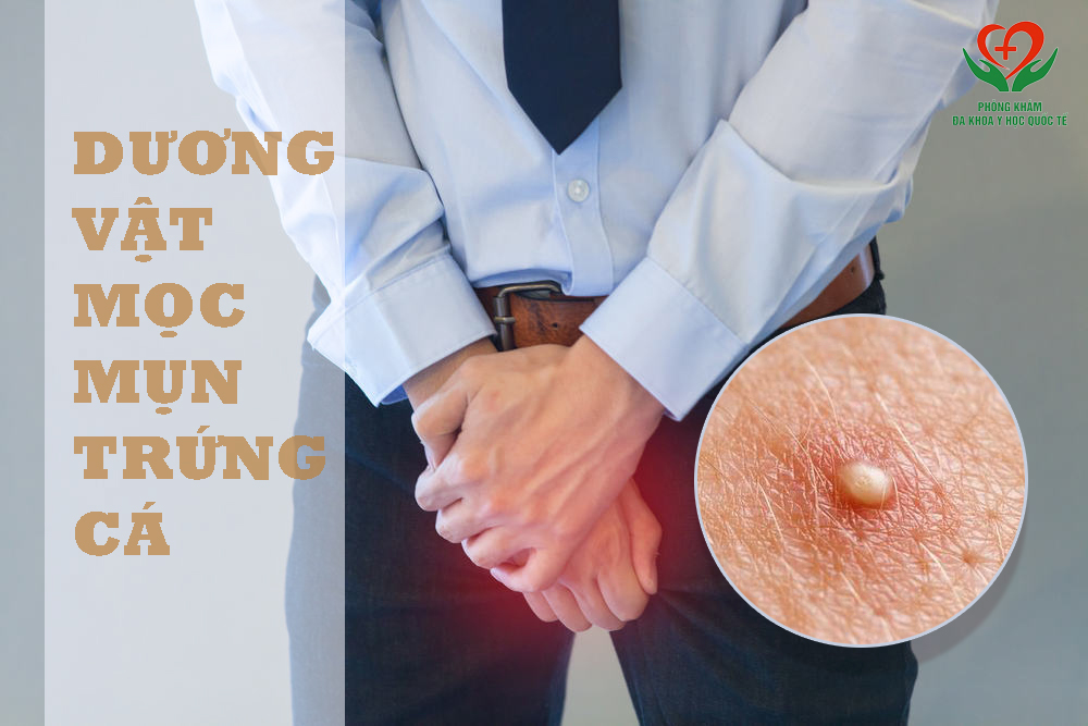 Dương Vật Mọc Mụn Trứng Cá Nguyên Nhân Và Cách điều Trị
